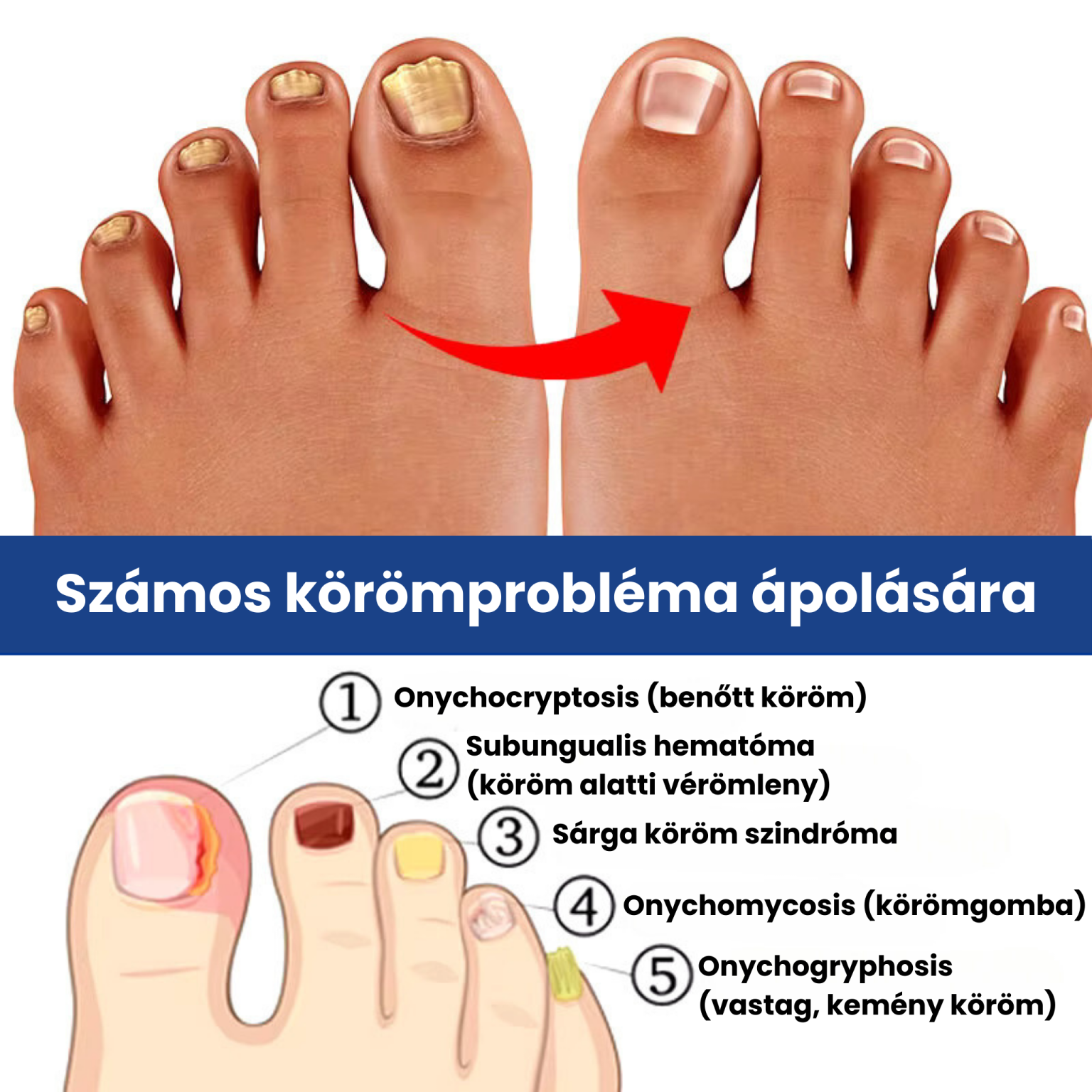 Fungi Tracker körömgomba elleni ecsetelő toll 3ml – körömgomba elleni ...